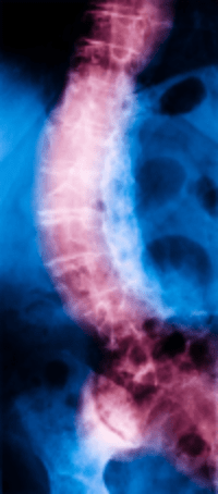 Understanding Spinal Deformities | Spine Institute of Nevada