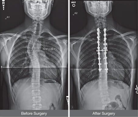 Non Surgical Spinal Decompression Therapy & Treatment